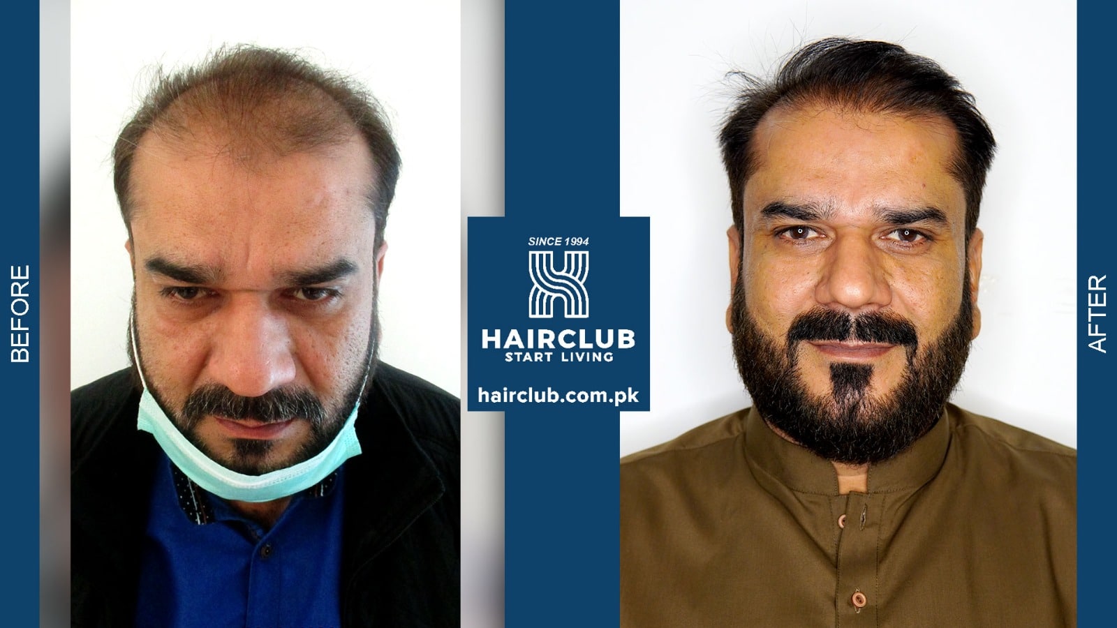 Hair Restoration Before and After Pictures | Hair Club