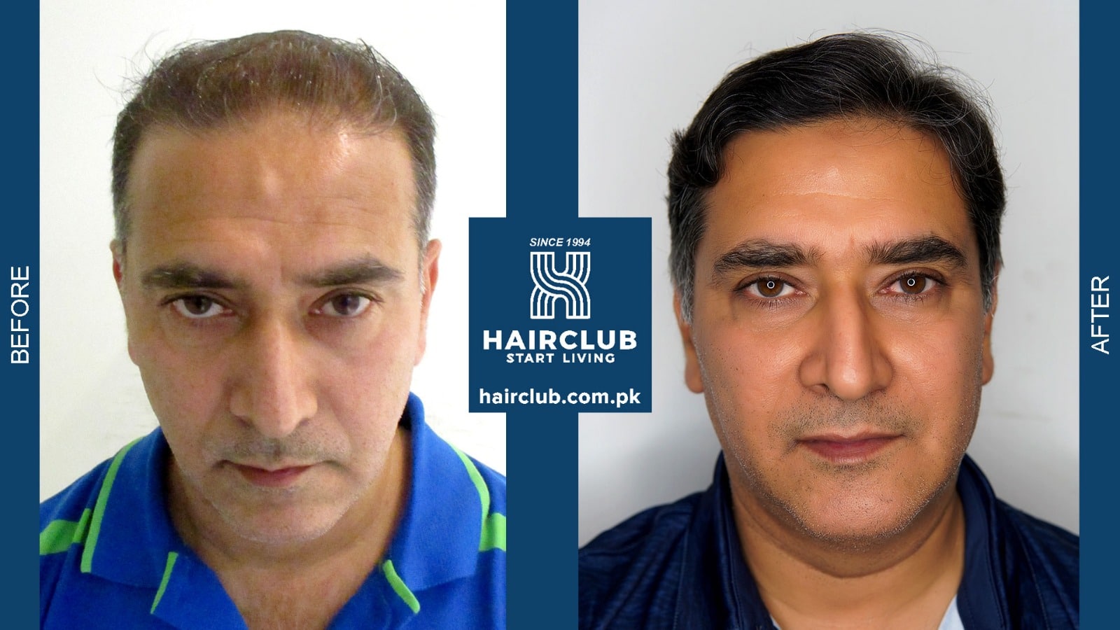 Hair Restoration Before and After Pictures | Hair Club